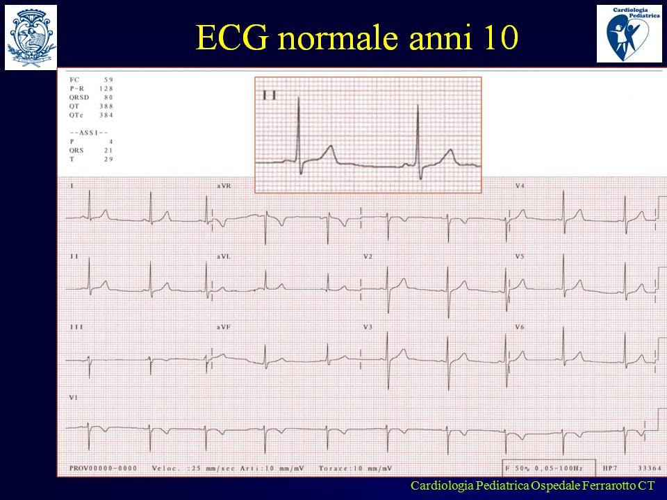 Ecg Normali e Patologici – Cardiologia Pediatrica