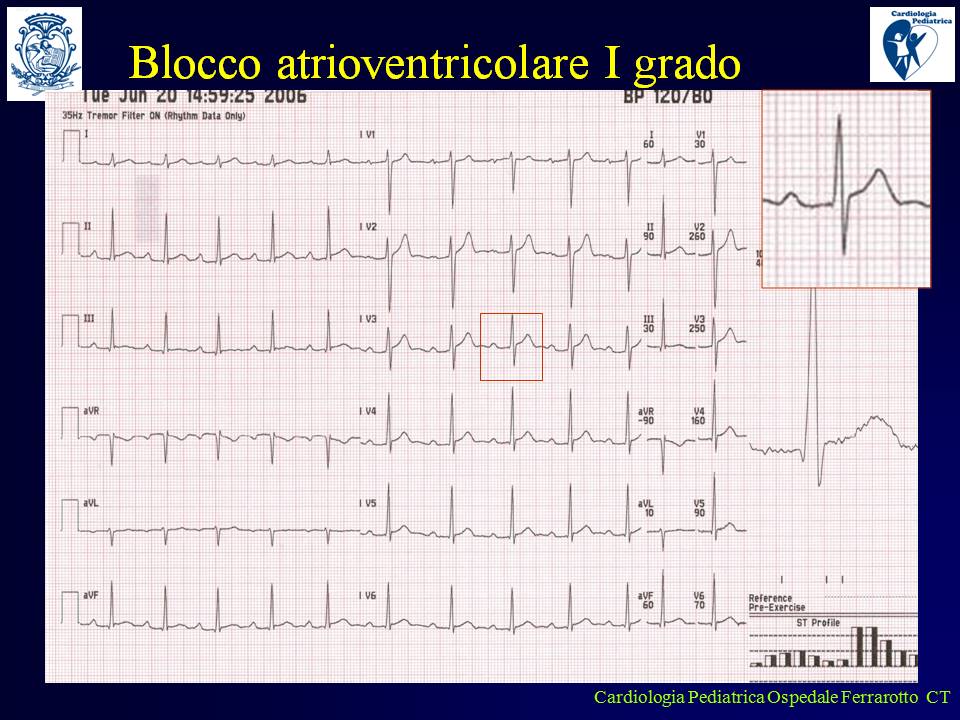 Ecg Aritmie – Cardiologia Pediatrica