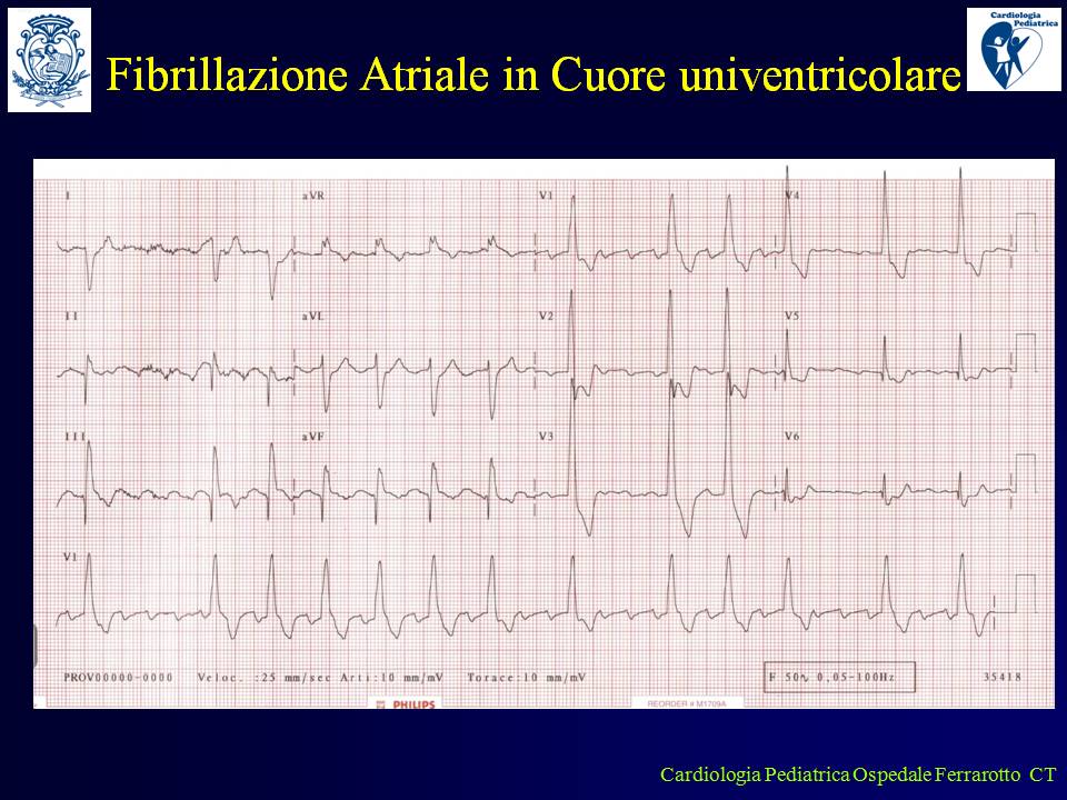 Ecg Aritmie – Cardiologia Pediatrica
